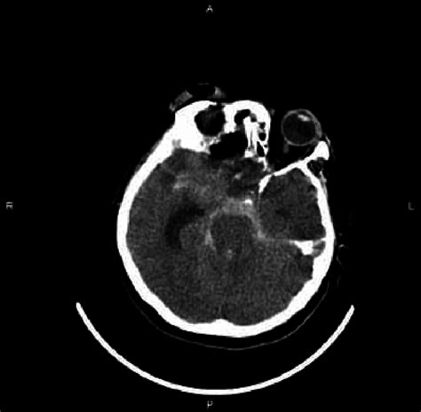 Postoperative Ct Scan Of The Patient Confirming Total Removal Of The