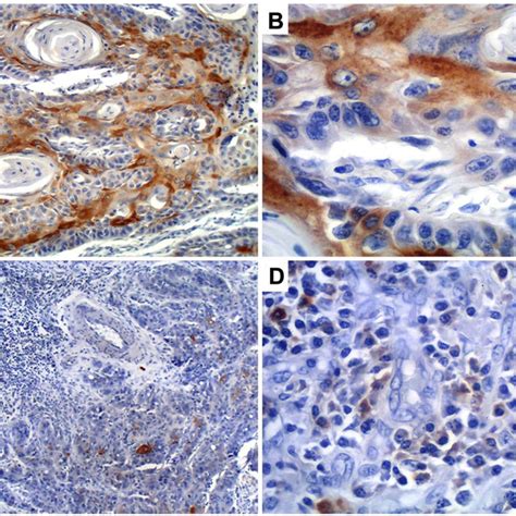 Differential Immunoexpression Of Cd 1 In Oscc A Lower Expression In