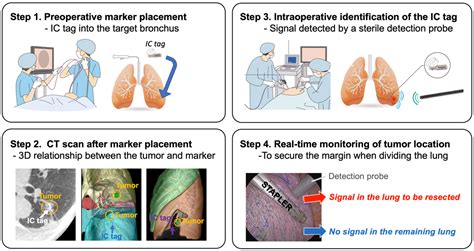 Segmentectomy For Lung Cancer Encyclopedia Mdpi