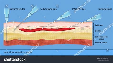 Layers Of Skin Injection At Harry Stedman Blog
