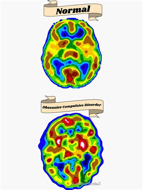 Copy Of Normal Vs Ocd Brain Scan Sticker For Sale By Xlesserpandax Redbubble