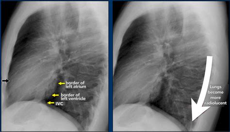 X Ray Normal Lung