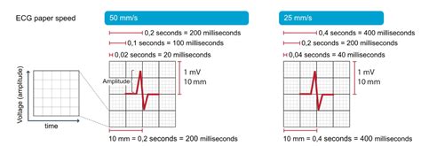 Ecg Interpretation Made Simple Moc Stepwise Approach