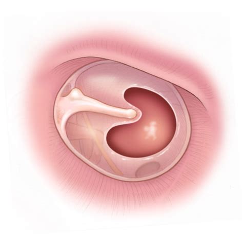 Perforated Tympanic Membrane Cks