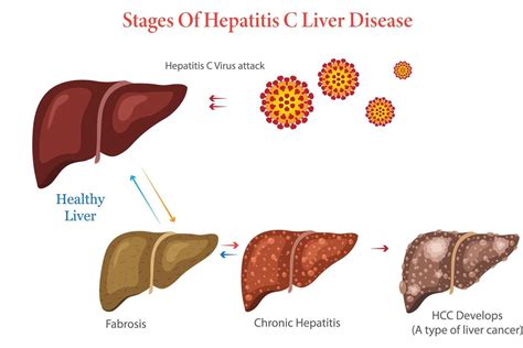 Hepatitis C Liver Disease