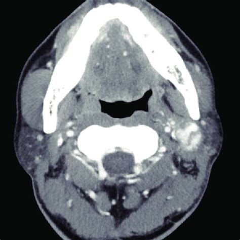 Patient Positioning For Left Robotic Partial Nephrectomy Download Scientific Diagram