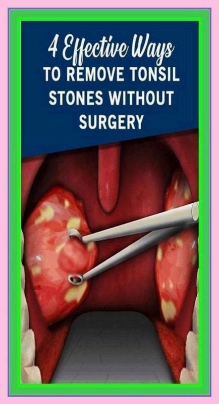 Let Me Know What I Can Do For You Refreshing Info Tonsil Stones