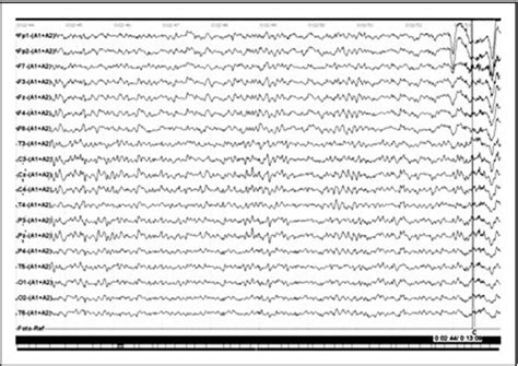 Figure 1 From Eeg Current Source Density And The Phenomenology Of The