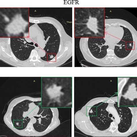 Lung Cancer Ct Images Including The Egfr Mutant And Egfr Wild Image Samples Download