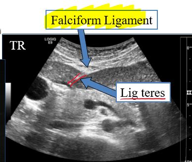 Falciform Ligament Ultrasound