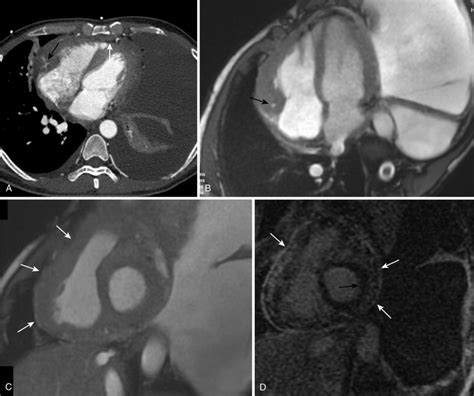 Myocardium Pericardium And Cardiac Tumor Clinical Tree