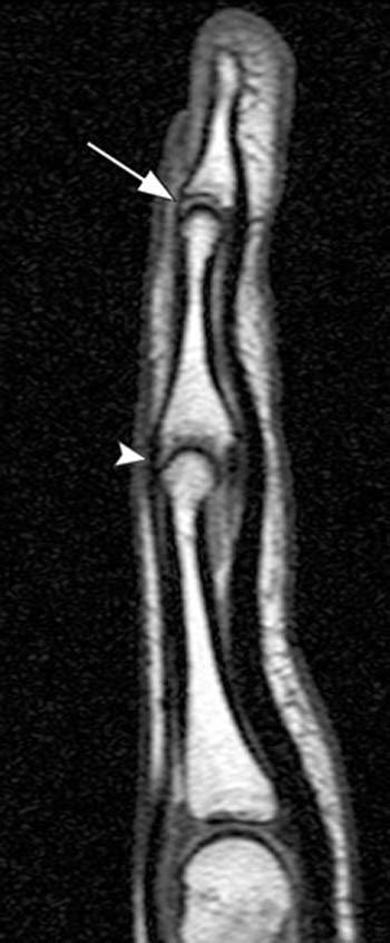 Extensor Tendon Injuries Of The Finger Radsource