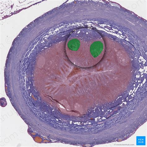 Subhepatic Appendicitis Symptoms Diagnosis Treatment Kenhub