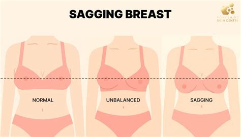 Sagging Breasts Everything You Need To Know About Breast Ptosis