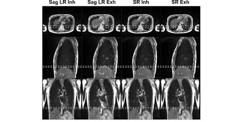 Comparison Of The Four Dimensional Super Resolution Sr Reconstruction