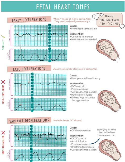 Fetal Heart Tones Normal Ranges Decelerations Causes And Interventions