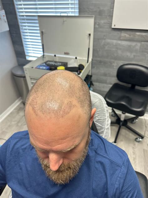 How Many Sessions Does It Take To Get Scalp Micropigmentation