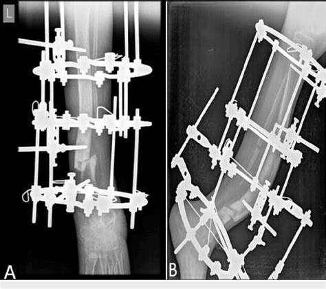 Figure From Congenital Pseudoarthrosis Of Tibia With Anterolateral