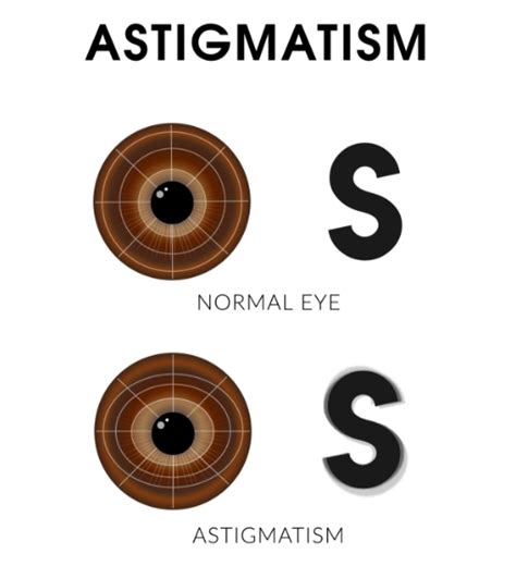 Astigmatism Symptoms Causes And Treatment Lions Eye Institute