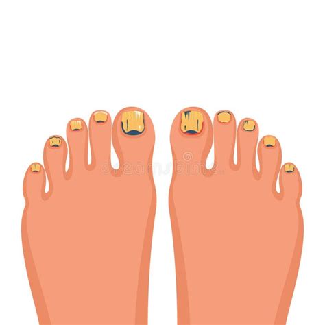 Fungal Skin Infection Stock Illustrations 1479 Fungal Skin Infection
