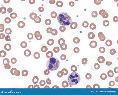 Eosinophils In A Chronic Myeloproliferative Syndrome Royalty Free