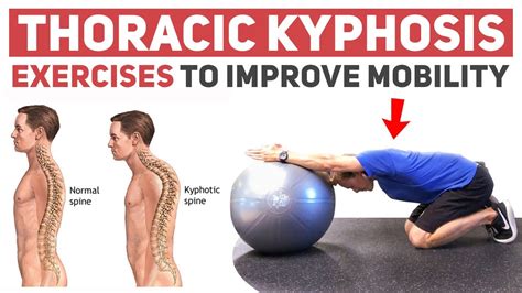 Kyphosis Exercises To Correct