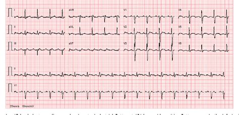 Figure 1 From Late Atypical Atrial Flutter After Ablation Of Atrial Fibrillation Semantic Scholar
