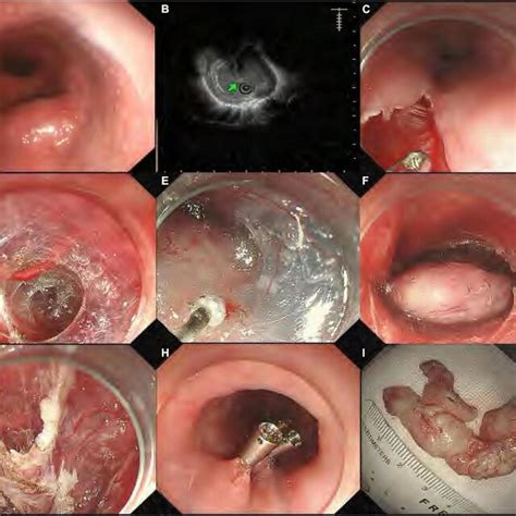 Submucosal Tunneling Endoscopic Resection Procedure For A Submucosal Download Scientific