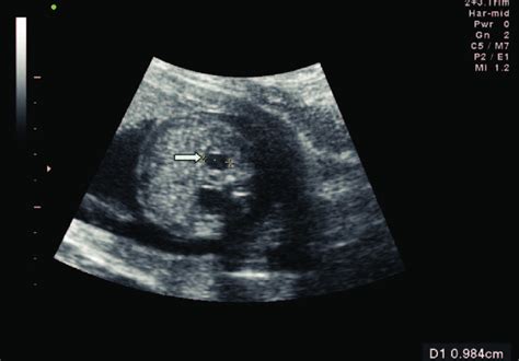 Pyelectasis Vs Pelviectasis