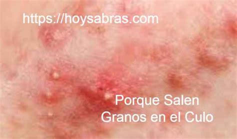 Granos En El Ano Que Pican Womanooze