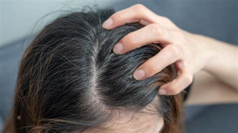 Itchy Scalp And Hair Loss Dermatologists Reveal The Surprising Cause How To Speed Regrowth