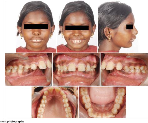 Class Ii Malocclusion