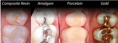 Dental Tooth Filling Cost Guide Types Benefits And Price