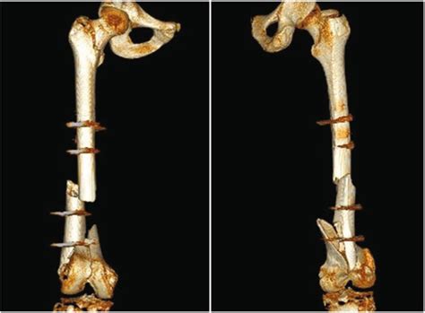 3d Reconstruction Of A Segmental Fracture Of The Distal 1 3 Of The