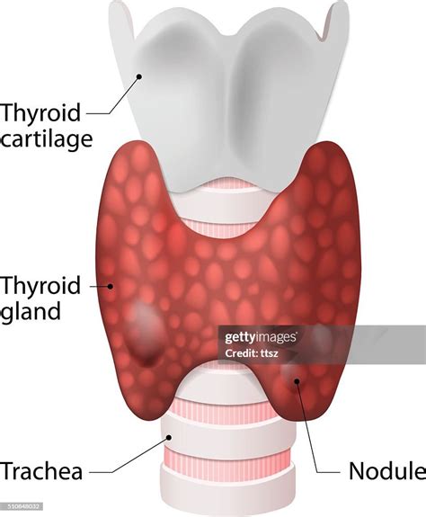 Thyroid Nodules High Res Vector Graphic Getty Images