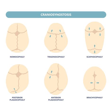Craniosynostosis Pensacola Oral And Facial Surgery Pensacola Fl