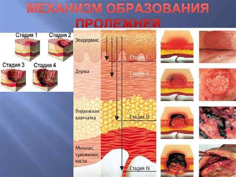 ПРОФИЛАКТИКА ОПРЕЛОСТЕЙ И ПРОЛЕЖНЕЙ