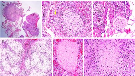 Figure 1 From Different Phenotypes Of Sarcomeric Mybpc3 Cardiomyopathy