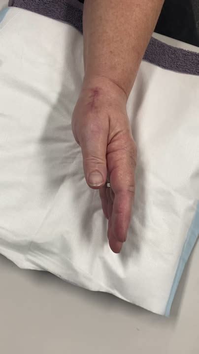 Sharon Chu On Linkedin Arom At 6 Weeks Post 1st Cmcj Touch™️replacement Arthroplasty Redimed…