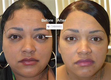 Graves Disease Before And After Gallery Taban Md