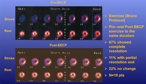 Rachel Liu On Linkedin Eecp Cardiovascular Fda Circulatory Heartsurgery Cardiac Cardiology