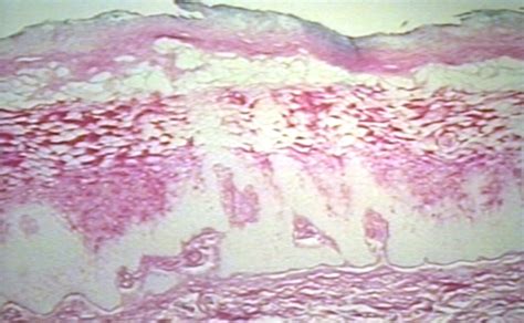 Hairy Leukoplakia Histology