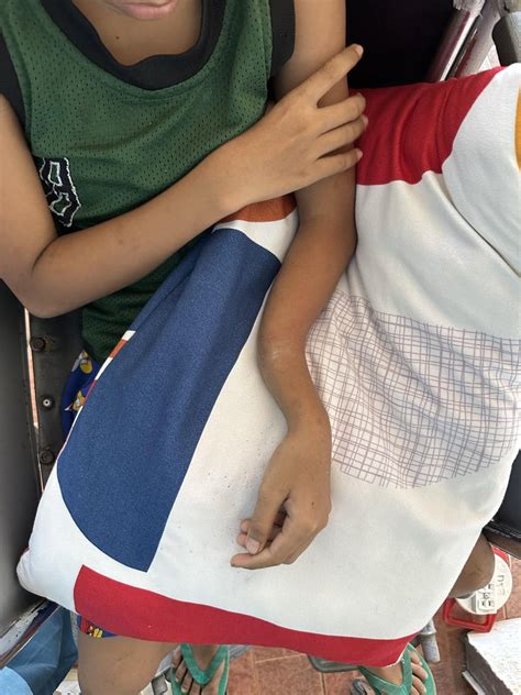 S P Orif Plating M 3rd Radius And Ulna Left R Radiology