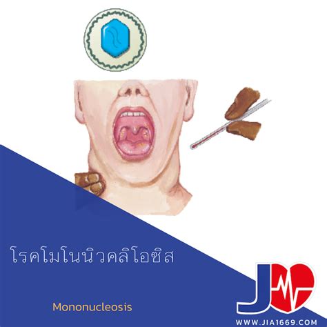 Mononucleosis Jia1669