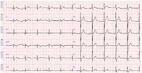 Electrocardiograma De 12 Derivaciones Download Scientific Diagram