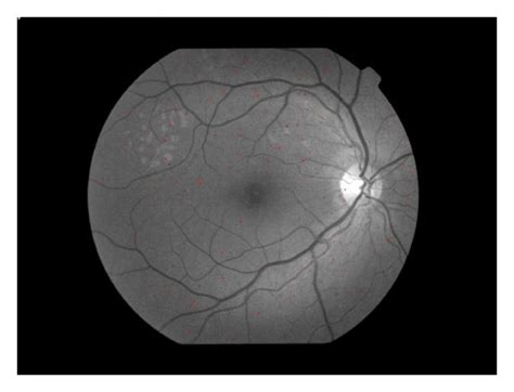 Microaneurysm Detection A Original Retina Image B Clahe Contrast