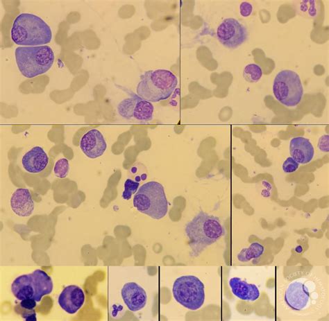 Plasma Cell Myeloma 2