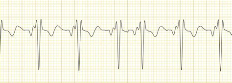ADS ECG Waveform Not Stable Getting Inverted QRS Complex Sometimes Data Converters