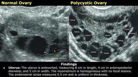 Understanding Polycystic Ovary Ultrasound What It Reveals And When You