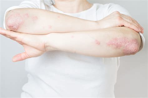 Plaque Psoriasis Causes Triggers Symptoms Treatments